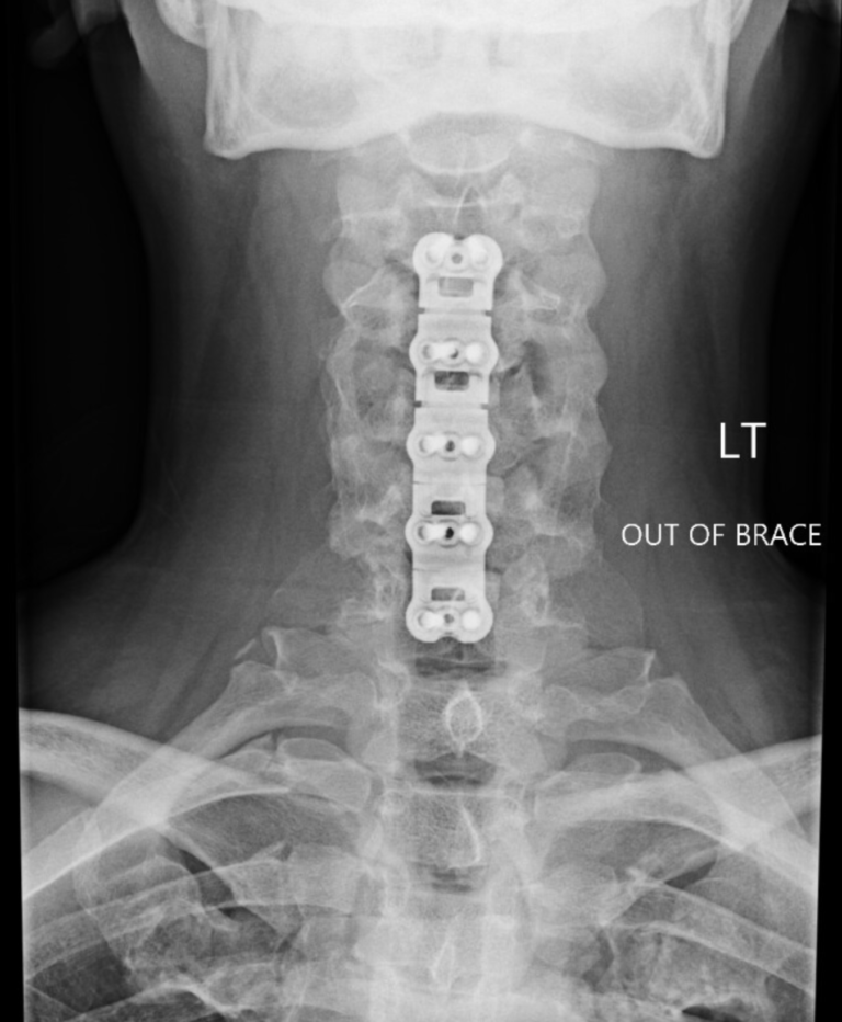 Eleven Weeks Since ACDF Surgery – Learn At My Expense