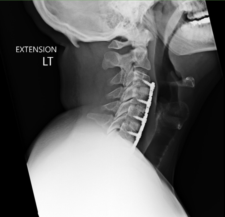 Four Month Update ACDF Surgery – Learn At My Expense