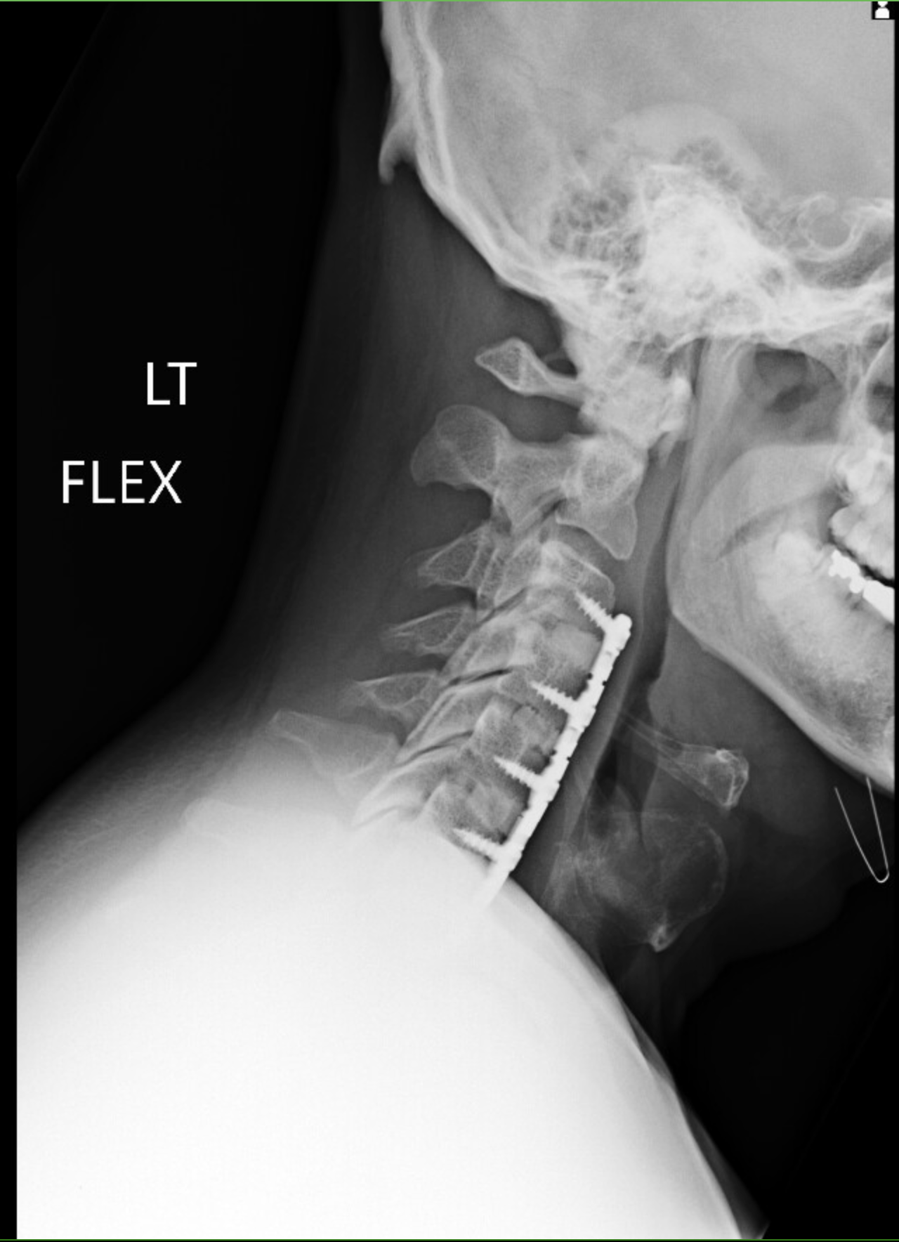 Four Month Update ACDF Surgery – Learn At My Expense